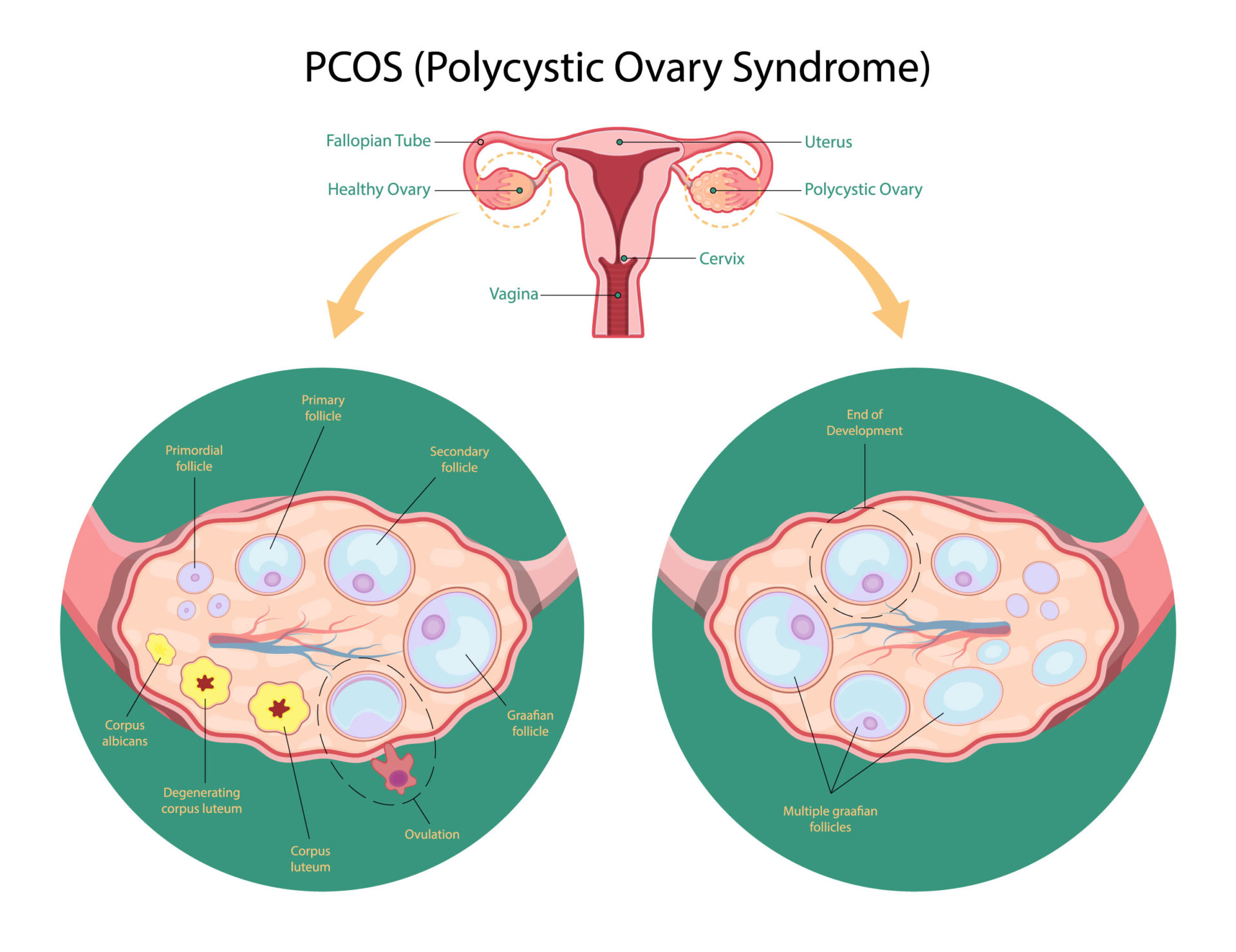 Can CBD Help with PCOS? Benefits, Dosage, & Side-Effects — Daily CBD